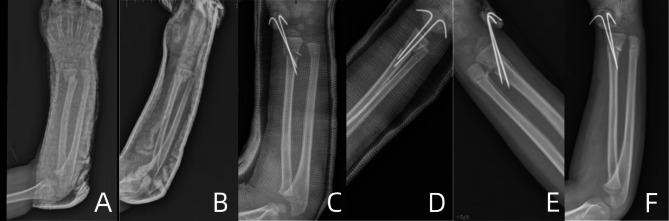 Pediatric distal both-bone forearm fractures treated with percutaneous pinning with or without ...