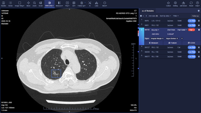 Deep learning reconstruction improves computer-aided pulmonary nodule detection and measurement ...
