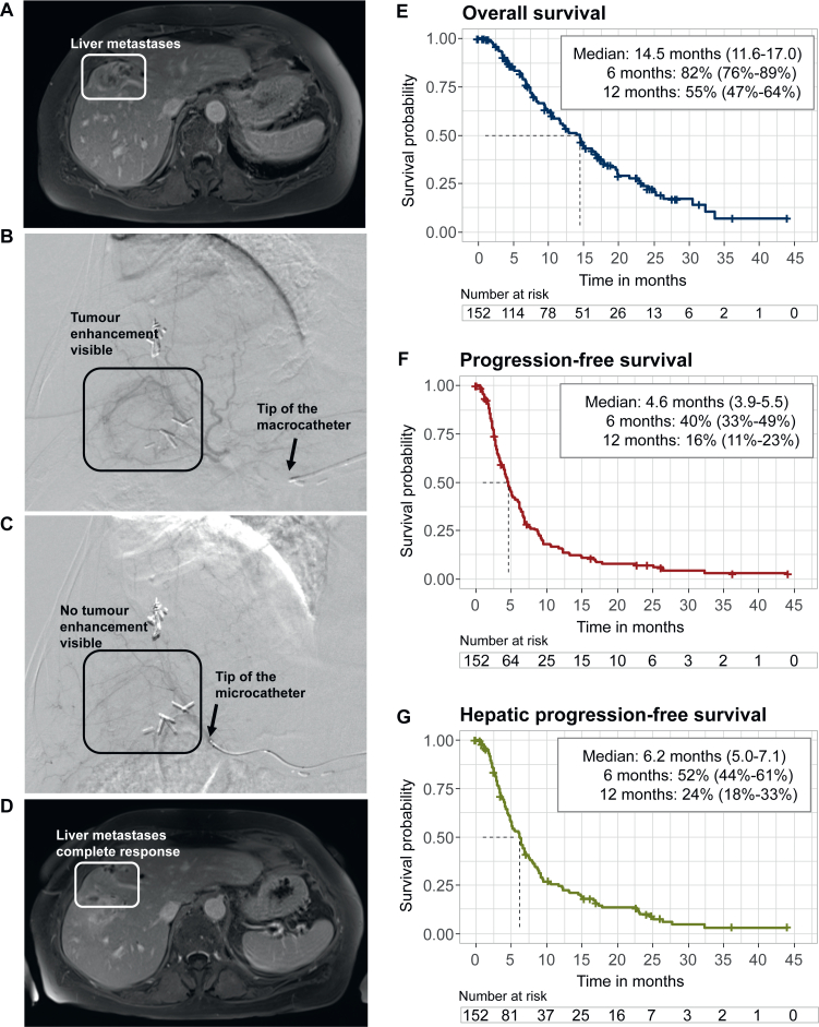 Transarterial chemoembolisation with irinotecan (irinotecan-TACE) as salvage or post-inductive ...