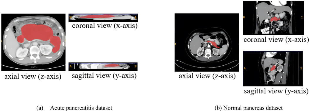 Automated CT Pancreas Segmentation for Acute Pancreatitis Patients by combining a Novel Object ...