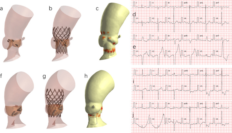 Predicting new-onset persistent conduction disturbance following transcatheter aortic valve ...