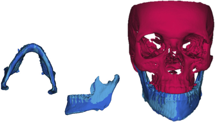 Three-dimensional quantification of mandibular asymmetries in Caucasian adult patients with ...