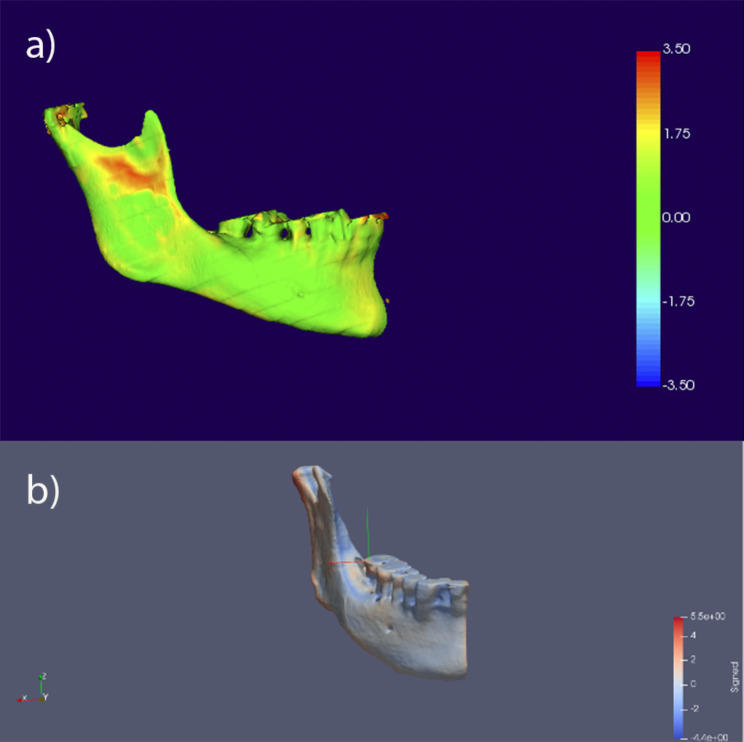 Three-dimensional quantification of mandibular asymmetries in Caucasian adult patients with ...