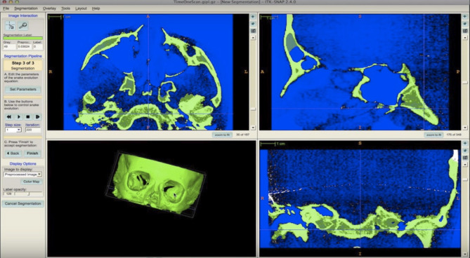 Three-dimensional quantification of mandibular asymmetries in Caucasian adult patients with ...
