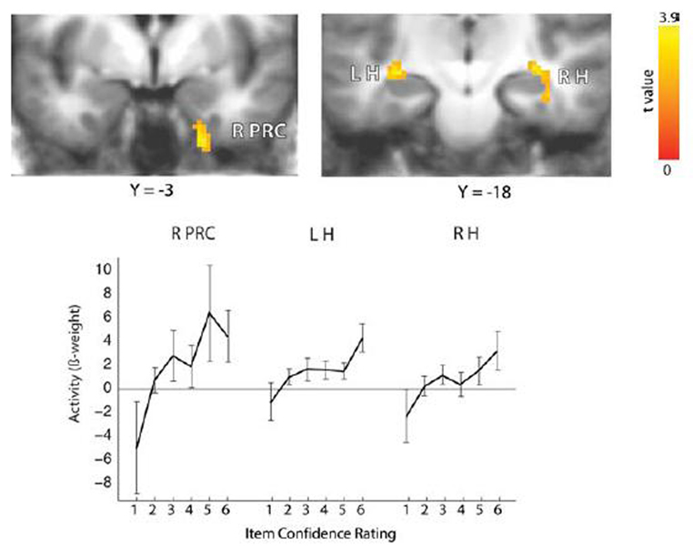 The role of the human hippocampus in familiarity-based and recollection-based recognition memory ...