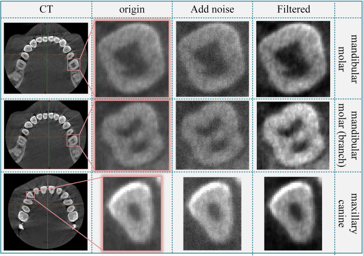 Accuracy evaluation of dental CBCT and scanned model registration method based on pulp horn ...
