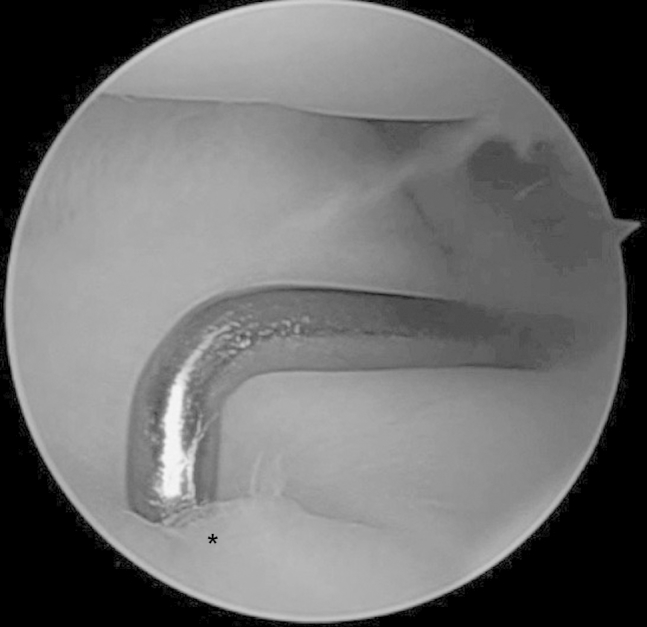 Arthroscopic-Assisted Outside-In Repair of Triangular Fibrocartilage Complex Tears - PMC