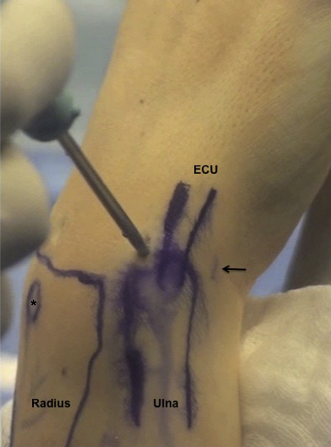 Arthroscopic-Assisted Outside-In Repair of Triangular Fibrocartilage Complex Tears - PMC