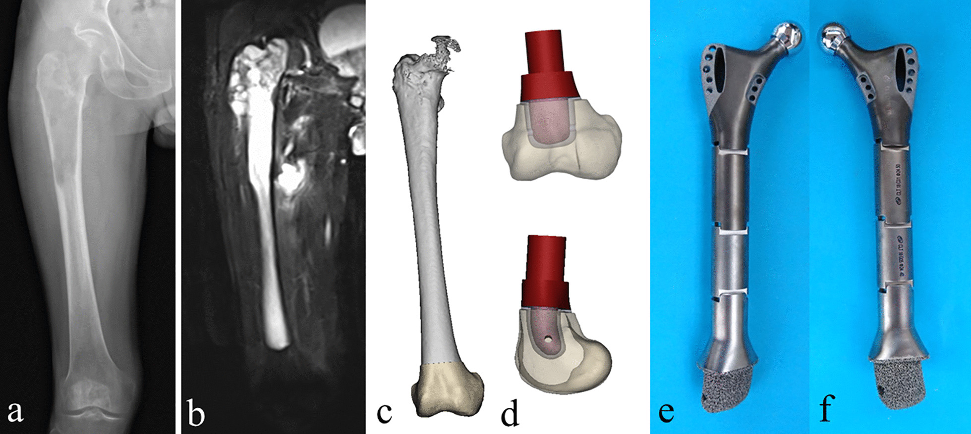 3D-printed custom-made short stem with porous structure for fixation of massive endoprosthesis ...