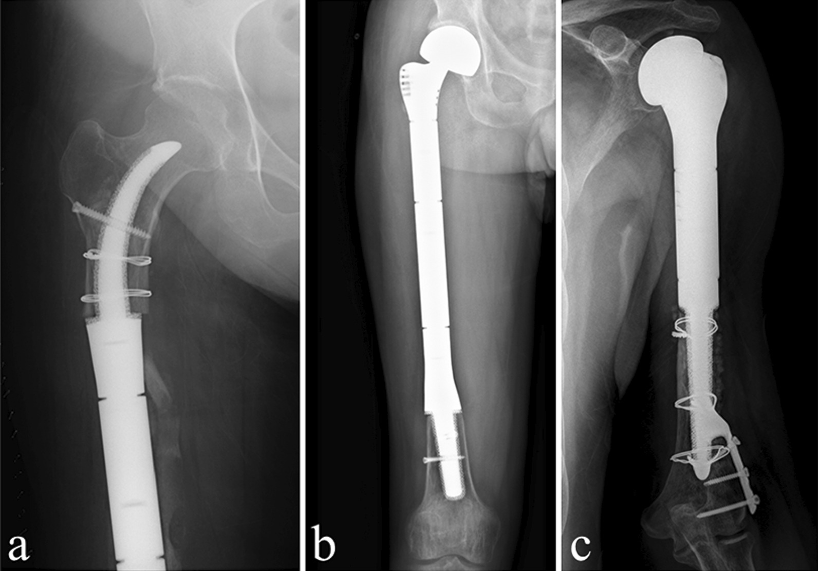 3D-printed custom-made short stem with porous structure for fixation of massive endoprosthesis ...