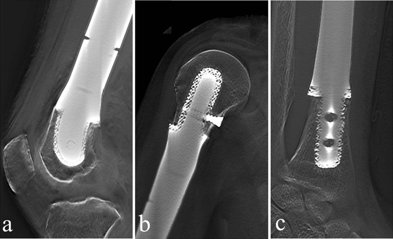 3D-printed custom-made short stem with porous structure for fixation of massive endoprosthesis ...