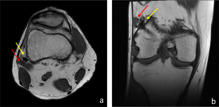 Accessory plantaris muscle can result in symptomatic hardware impingement following ACL ...
