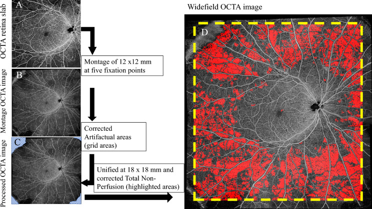 Relationship between nonperfusion area from widefield optical coherence tomography angiography ...