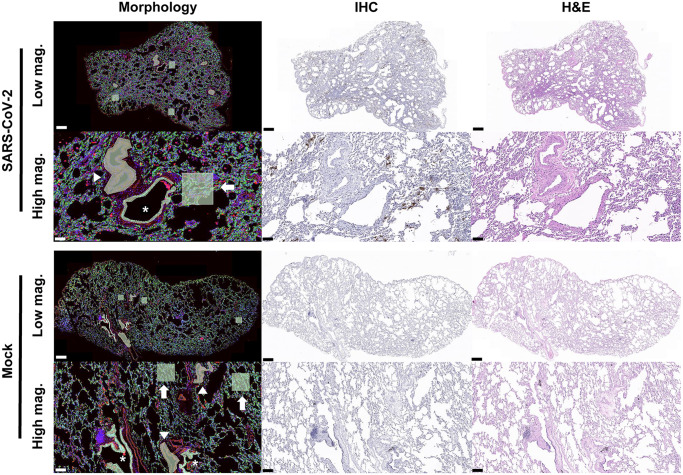 Spatial transcriptome atlas reveals pulmonary microstructure-specific COVID-19 gene signatures ...