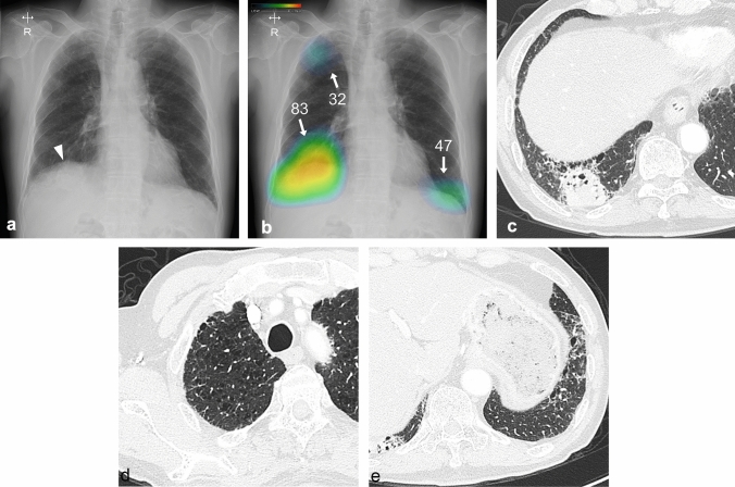 Performance of artificial intelligence-based software for the automatic detection of lung ...