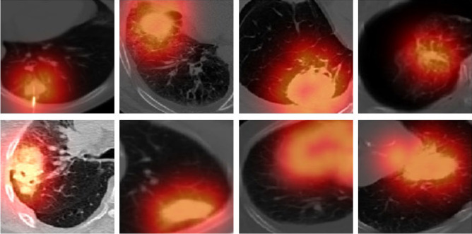 Enhanced lung cancer subtype classification using attention-integrated ...