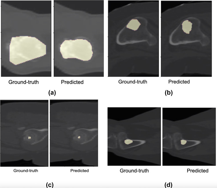 Automated Bone Tumor Segmentation and Classification as Benign or Malignant Using Computed ...