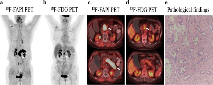 [18F] AlF‑NOTA‑FAPI‑04 PET/CT as a promising tool for imaging fibroblast activation protein in ...