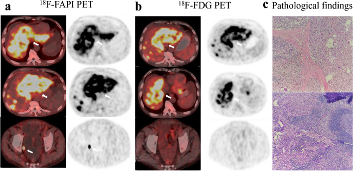 [18F] AlF‑NOTA‑FAPI‑04 PET/CT as a promising tool for imaging fibroblast activation protein in ...