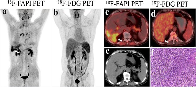 [18F] AlF‑NOTA‑FAPI‑04 PET/CT as a promising tool for imaging fibroblast activation protein in ...