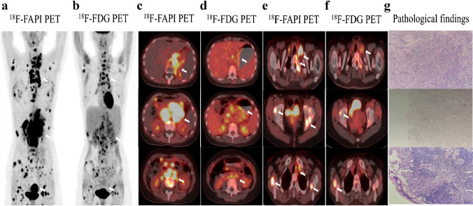 [18F] AlF‑NOTA‑FAPI‑04 PET/CT as a promising tool for imaging fibroblast activation protein in ...
