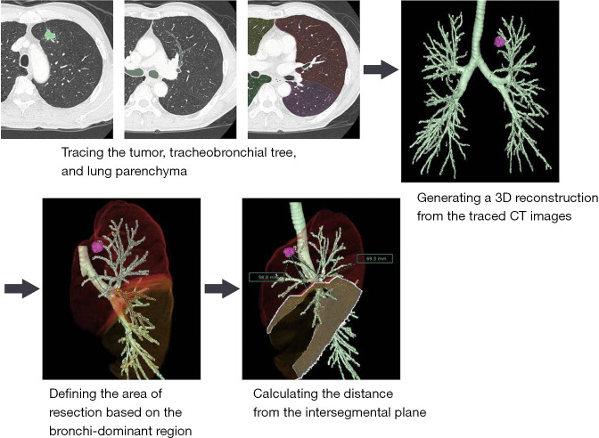Comparison of oncological outcomes between trisegmentectomy and lobectomy for non-small cell ...