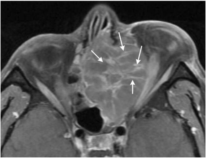 Correction to: Differential diagnosis of sinonasal extranodal NK/T cell lymphoma and diffuse ...