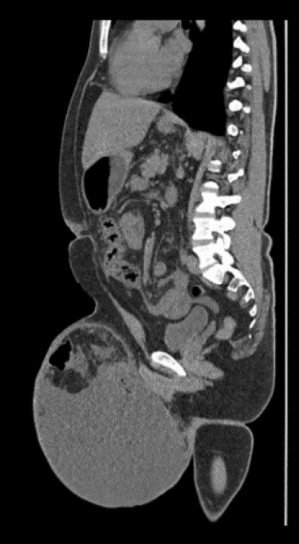 A case of giant inguinoscrotal hernia managed by preoperative pneumoperitoneum with an ...