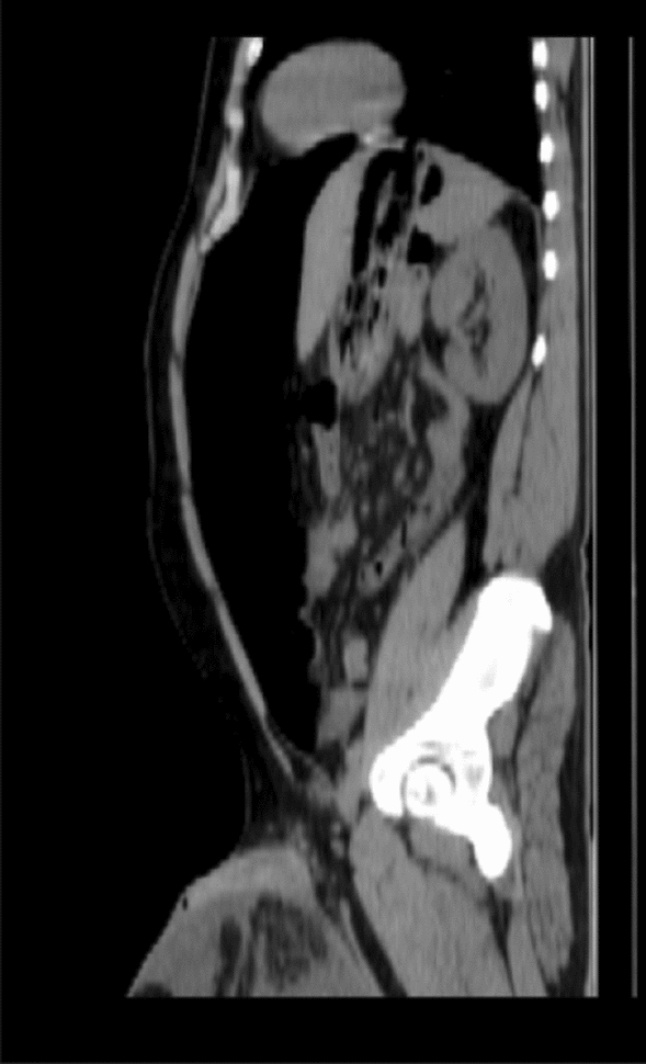 A case of giant inguinoscrotal hernia managed by preoperative pneumoperitoneum with an ...