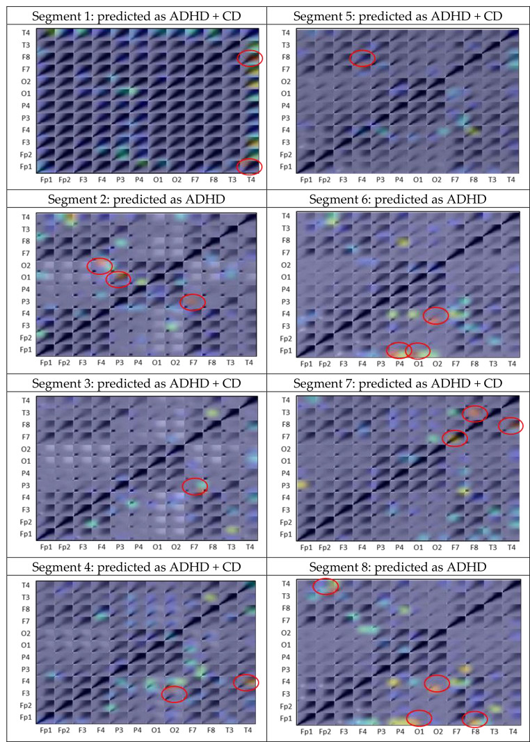 ADHD/CD-NET: automated EEG-based characterization of ADHD and CD using explainable deep neural ...
