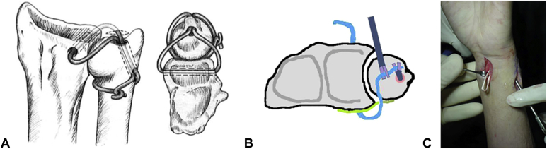 Arthroscopic-Assisted Repair of the Triangular Fibrocartilage Complex - PMC