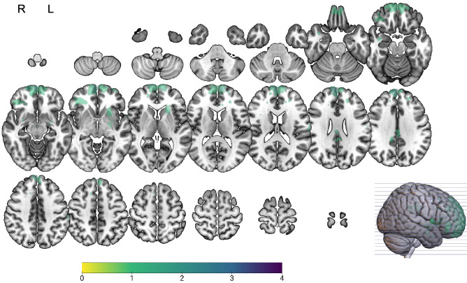 Temporal lobe activation during episodic memory encoding following traumatic brain injury - PMC