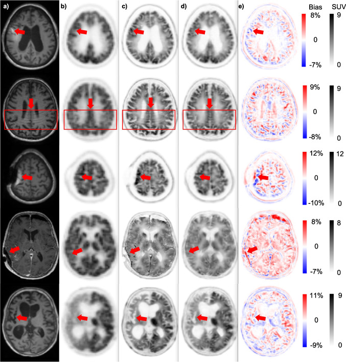 A cycle-consistent adversarial network for brain PET partial volume correction without prior ...
