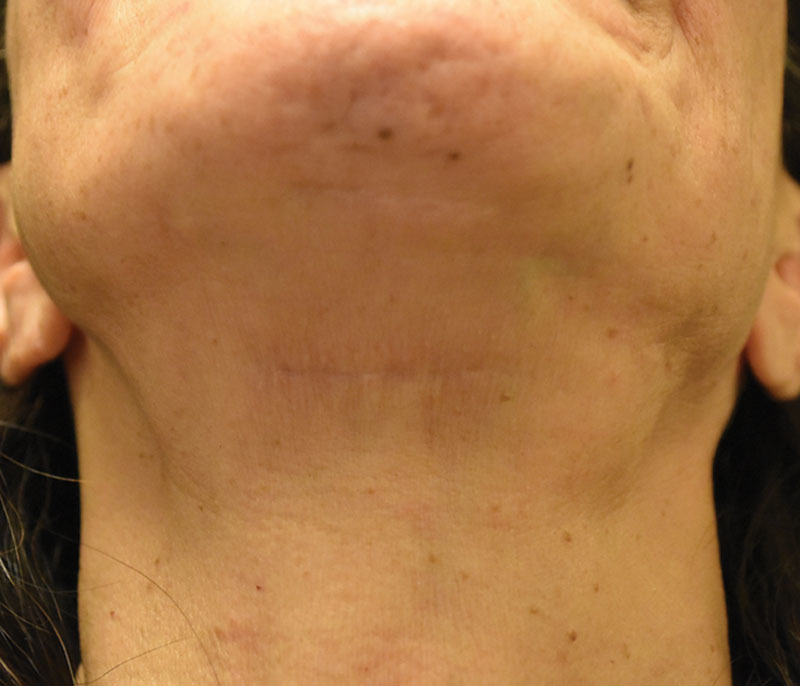 The Single Incision Minimally Invasive Simi Neck Lift Pmc