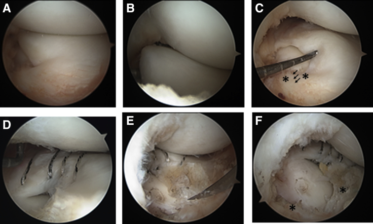 Meniscus Repair With Anterior Cord Release for Peripheral Tear Type of Discoid Lateral Meniscus ...
