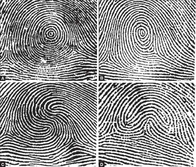 Dermatoglyphics A Noninvasive Diagnostic Tool In Predicting Class Iii