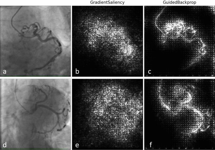 Novel deep learning method for coronary artery tortuosity detection ...