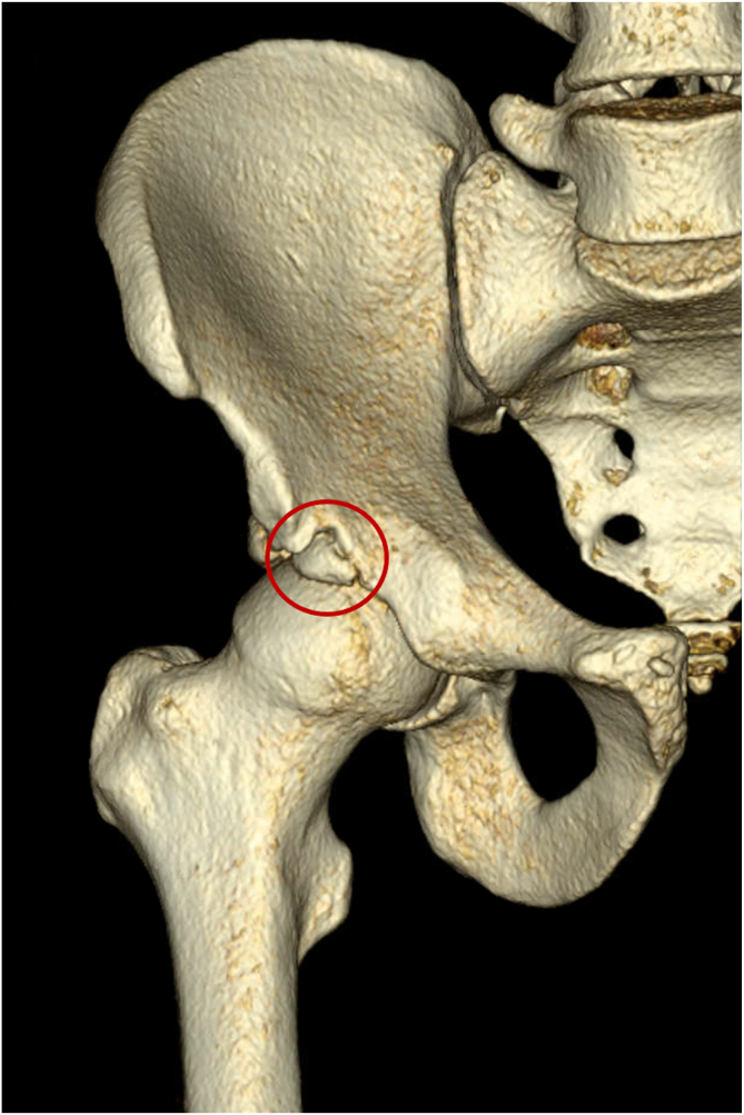 Os Acetabuli Do Not Portend Inferior 2-Year Functional Outcomes in Patients Undergoing ...