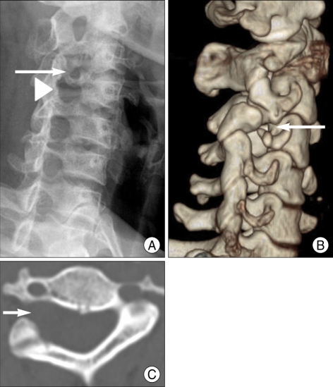 Congenital Absence Of A Cervical Spine Pedicle Report Of Two Cases