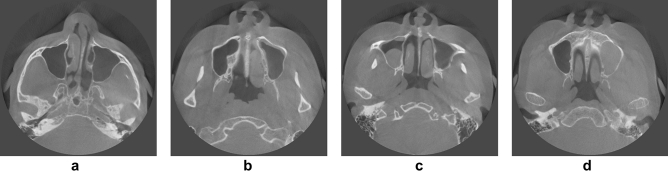 Deep learning-based fully automatic segmentation of the maxillary sinus on cone-beam computed ...
