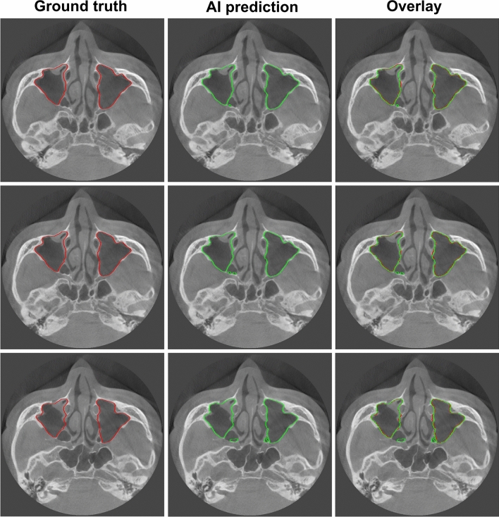 Deep learning-based fully automatic segmentation of the maxillary sinus on cone-beam computed ...