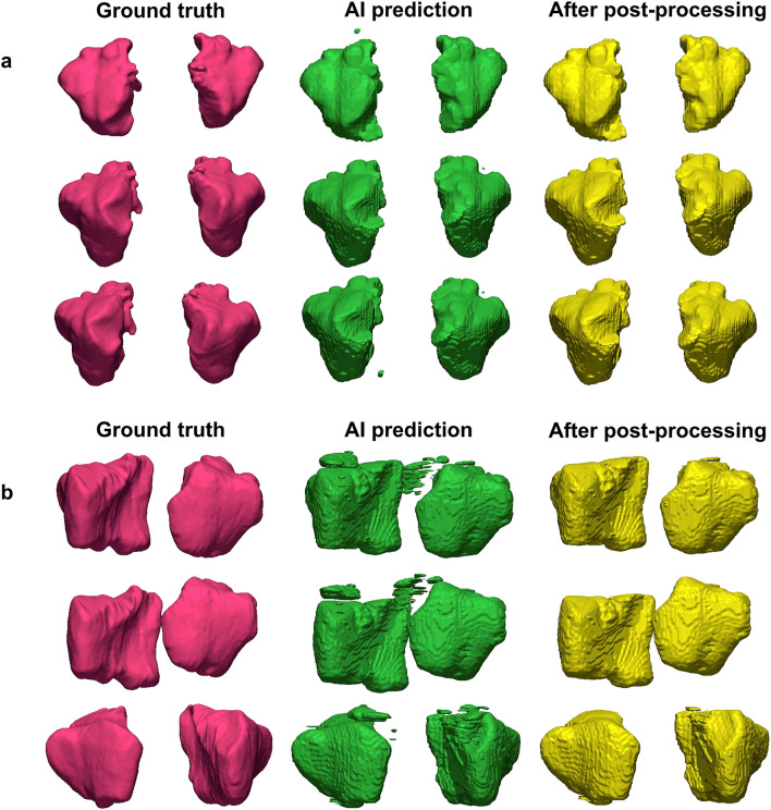 Deep learning-based fully automatic segmentation of the maxillary sinus on cone-beam computed ...