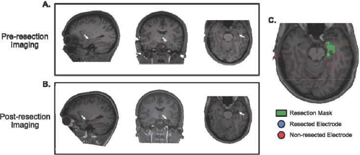 iEEG-recon: A Fast and Scalable Pipeline for Accurate Reconstruction of Intracranial Electrodes ...