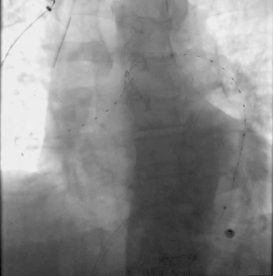 Interventional Therapy For Pulmonary Embolism Pmc