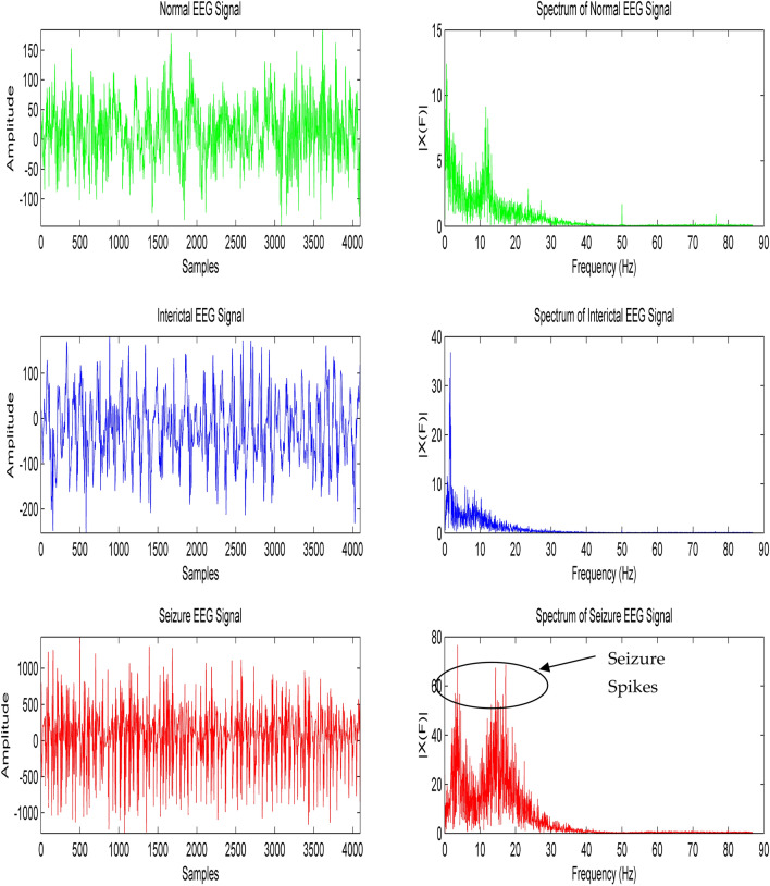 Eeg Based Epileptic Seizure Detection Using Binary Dragonfly Algorithm And Deep Neural Network Pmc