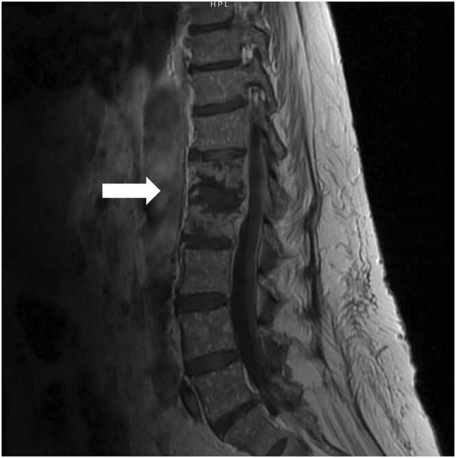 Mycobacterium xenopi native vertebral osteomyelitis and discitis: Case & review of published ...