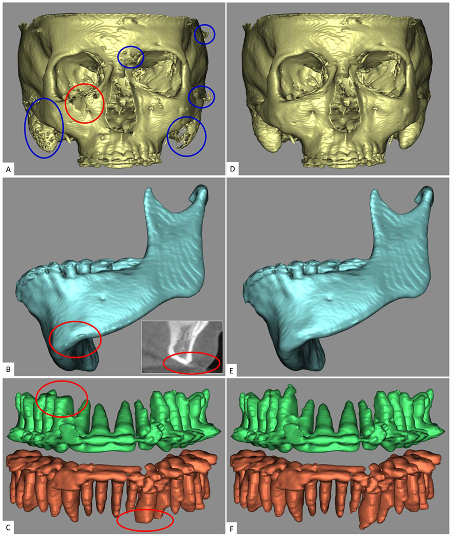 Clinical feasibility of deep learning-based automatic head CBCT image segmentation and landmark ...