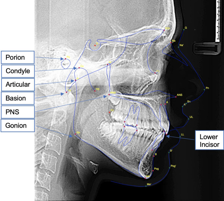 Reliability and accuracy of Artificial intelligence-based software for cephalometric diagnosis ...
