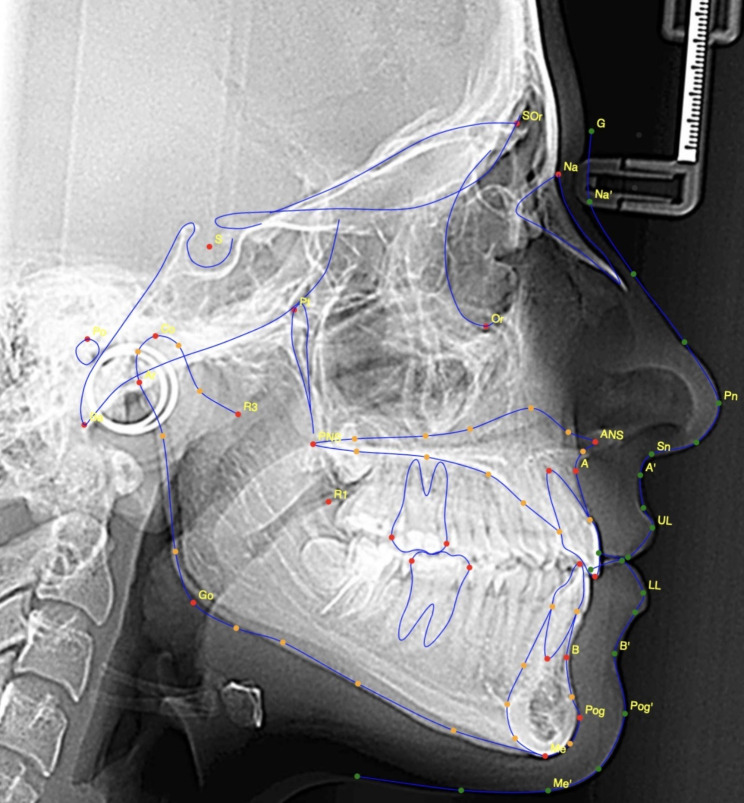 Reliability and accuracy of Artificial intelligence-based software for cephalometric diagnosis ...