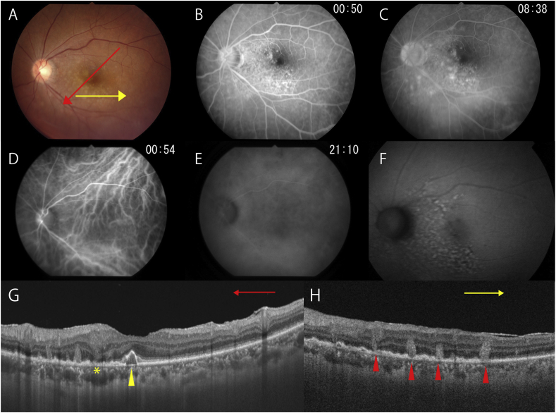 Multimodal imaging of secondary vitreoretinal lymphoma with optic neuritis and retinal ...